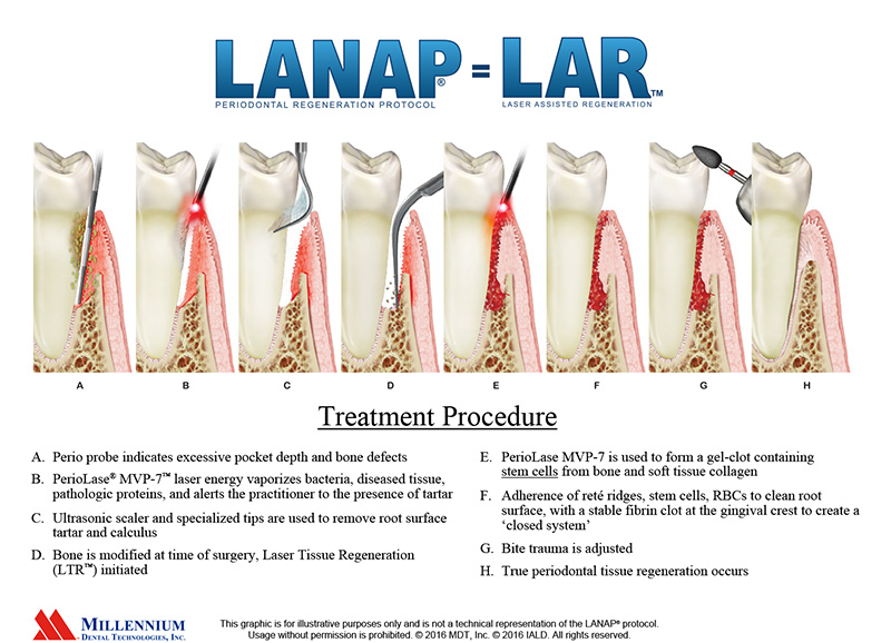 LANAP Laser Surgery Encinitas, CA | Gum Disease Treatment | Periodontist