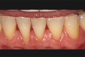 Gallery Gum Grafting | Periodontal Therapy | Smile Restoration